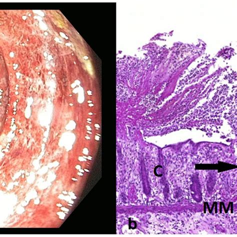 Typical Ultrasound Image In Ehec O Infection Left Sided Colitis Download Scientific Diagram