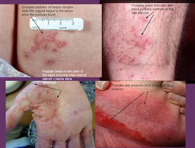 Dermatology Made Simple Pustular Diseases