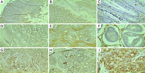 Immunohistochemical Staining Of Foxp3 Ab Immunohistochemical
