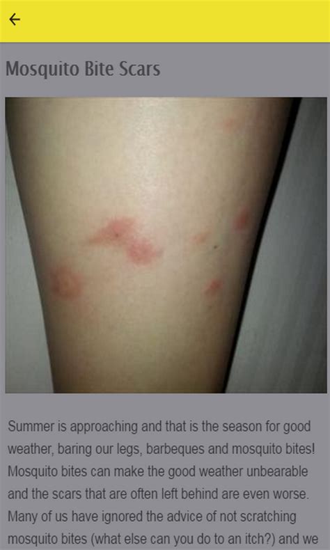 How To Get Rid Of Mosquito Bites App On Amazon Appstore