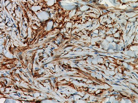 Factor Xiii Antibody Biocare Medical