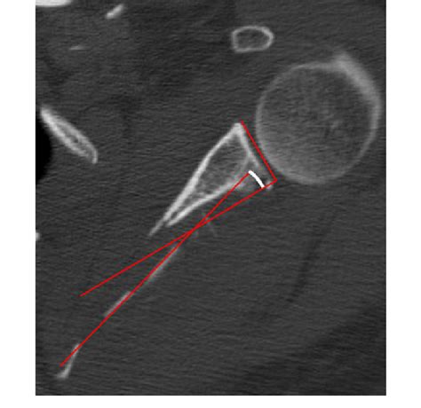 Measurement Of Glenoid Version On An Axial Ct Scan Image Is Download Scientific Diagram