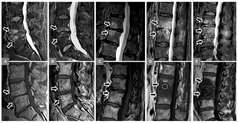 Visual Assessment Of The T1 W Signal Bottom Row Of Sagittal T1 W Download Scientific Diagram