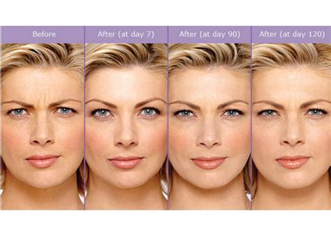 Botox For Wrinkles Jaw Slimming And More In Orange County