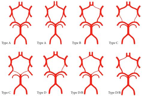 Common Variants Of The Circle Of Willis Diagrams