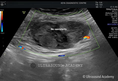 Acute Rectus Hematoma Case By Dr Nitin Jadhav