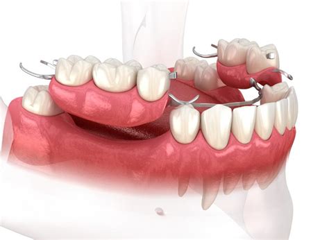 Partial Dentures Badea Dental Partial Dentures Badea Dental