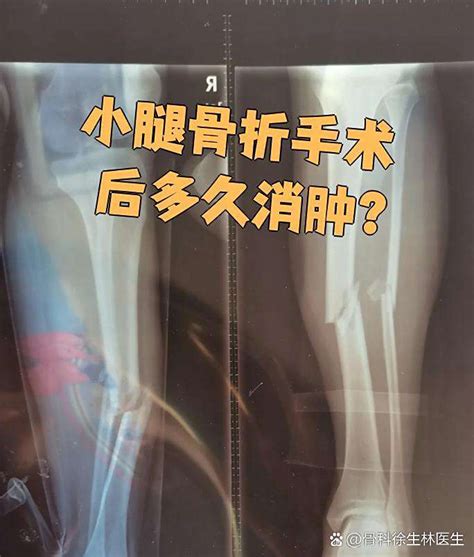 小腿骨折手术后多久消肿？