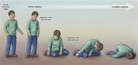 John D Bray Md Narcolepsy