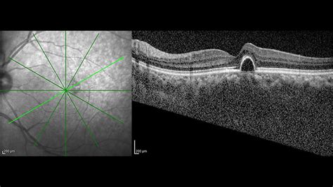 Parity For Oct Ivus In Intravascular Imaging Guided Pci Medical News Alley