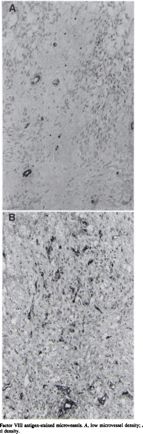 Figure 1 From Neovascularization In Clinical Stage A Testicular Germ Cell Tumor Prediction Of