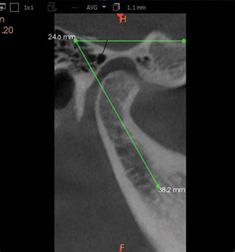 Three Dimensional Assessment Of Condylar Morphology Position And