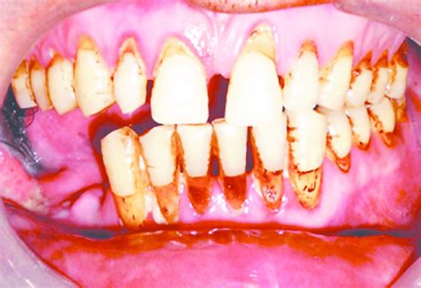 Four Months Postoperative Without Prosthesis Fig 6 Guide Flange Download Scientific Diagram