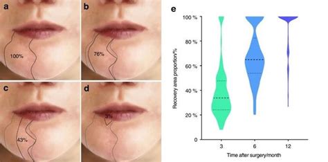 Lower Lip Sensation Loss After Mandibulectomy May Not Be Irreversible