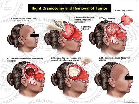 Right Craniotomy And Removal Of Tumor