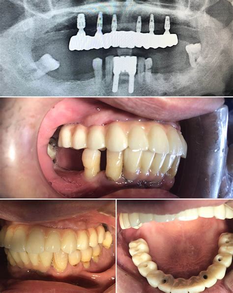 A One Year Follow Up Examining Bone Level Preservation Utilising Platform Switching Implants