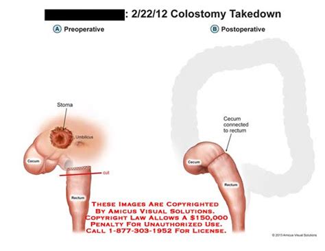 What Is The Cpt Code For Colostomy Reversal