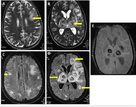 Magnetic Resonance Imaging Of The Brain A E Axial T2 Weighted Images
