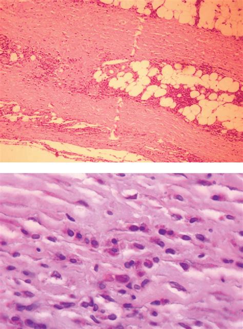 [pdf] Eosinophilic Fasciitis Shulman Syndrome Semantic Scholar