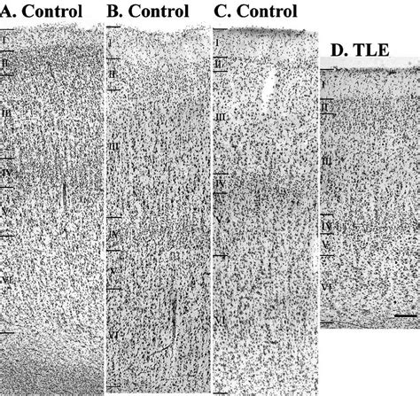 Photomicrographs Of Layers I Vi Of Temporal Neocortex In Controls Ac