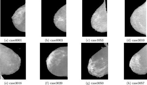 Set Of Digital Mammograms Download Scientific Diagram