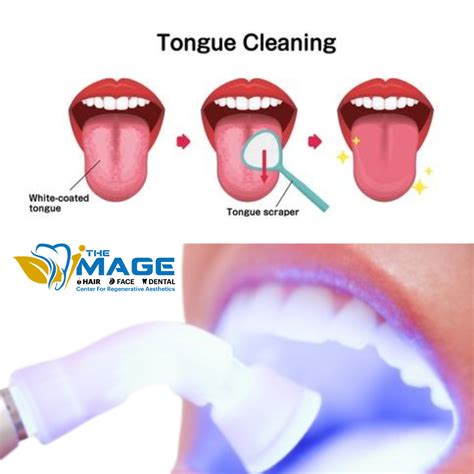White Tongue Coating Treatment