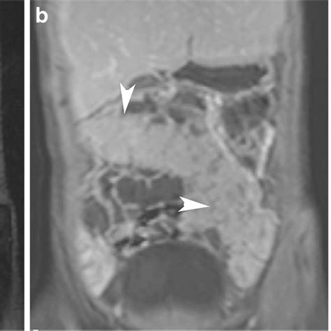 Severe Ulcerative Colitis Confirmed On Endoscopy In A Year Old Girl Download Scientific
