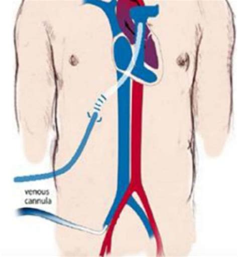 Early Liberal Use Of Ecmo Femoral Vein Pulmonary Artery As Temporary Rvad Vs Refractory Right