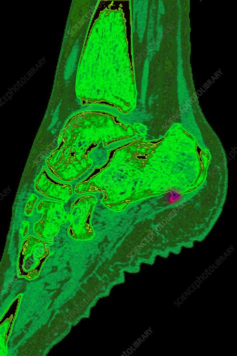 Enthesopathy Ct Scan Stock Image C026 8785 Science Photo Library