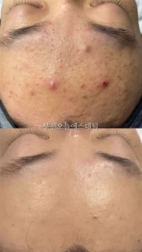 여드름 문제성피부전문 부천오늘에스테틱 성인여드름 압출만으로 깔끔하게 좋아지기 🕶️🖤 피부에 자극이 될 수 있는 필링이나