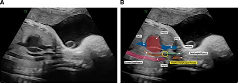 The Prenatal Detection Of Distal Tracheoesophageal Fistulas In Fetuses
