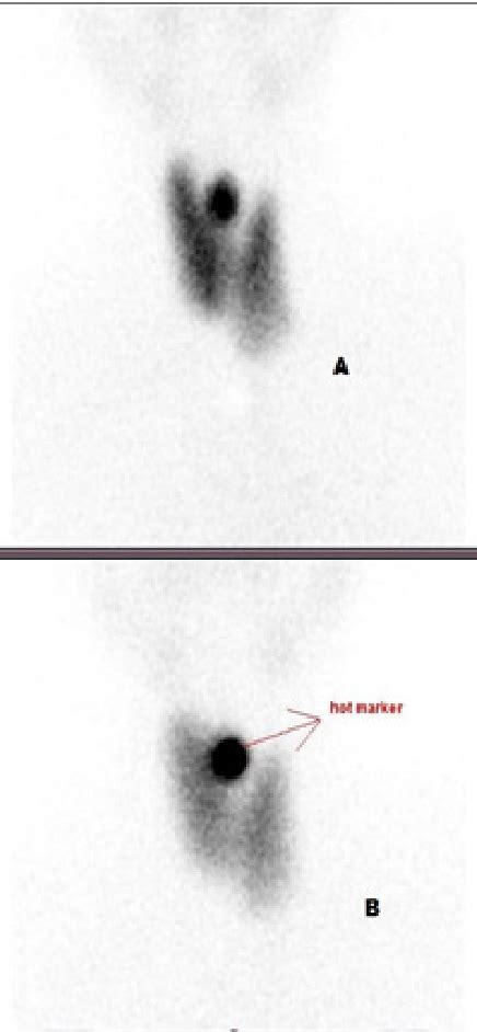 figure 3 from case report hot nodule in pyramidal lobe of thyroid gland