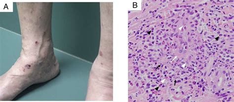 Skin Findings A Palpable Purpura On Both Legs B A Skin Biopsy