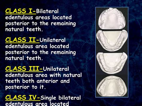 Classification Of Partially Edentulous Arches Pptx