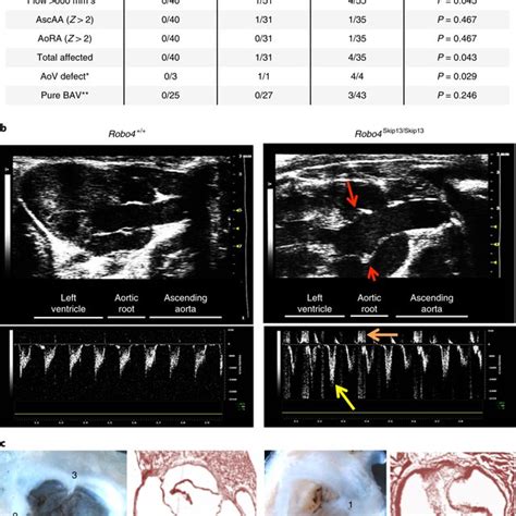 Evaluation Of Ascending Aortic Aneurysm Tissue Resected From Patient