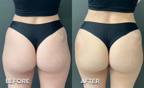 Buttocks Injections Before And After Photos