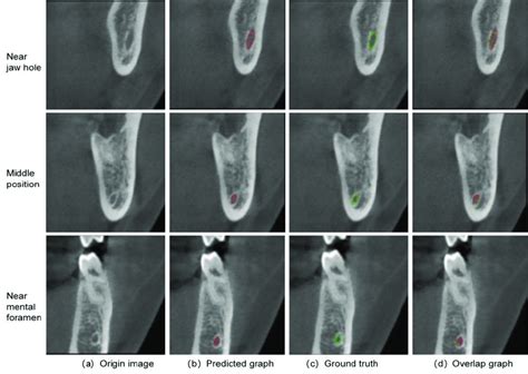 Schematic Diagram Of Mandibular Canal Segmentation Download