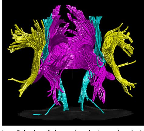 Figure 1 From Diffusion Tensor Mr Imaging Semantic Scholar