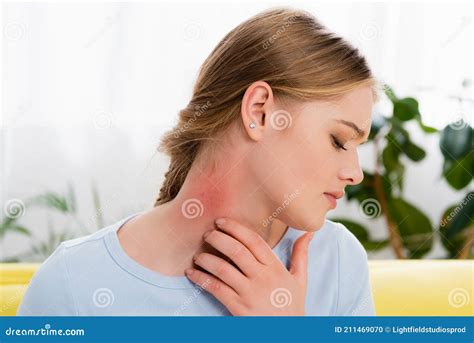 Woman With Allergy Redness On Neck Stock Photo Image Of Sickness Neck