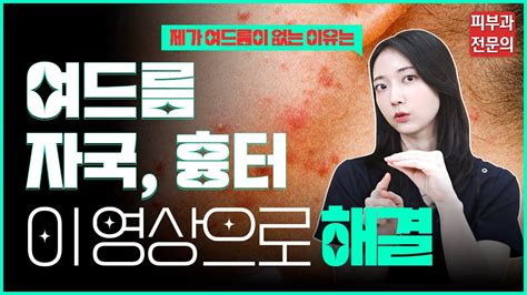 여드름 자국 흉터 없애는 법 홈케어 병원치료 정리 피부과전문의 Youtube
