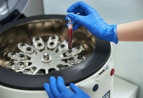 Hemoconcentration Causes Symptoms Treatment