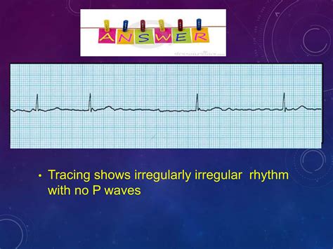 Acls Ekg Quiz Ppt