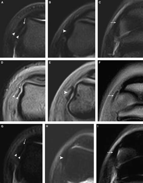 Transverse T2 Weighted Fast Spin Echo Fse Ac T1 Weighted