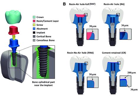 Three Dimensional Finite Element Models Structure Of The Implant