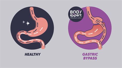 Sleeve Vs Bypass Analyzing The Two Leading Weight Loss Procedures
