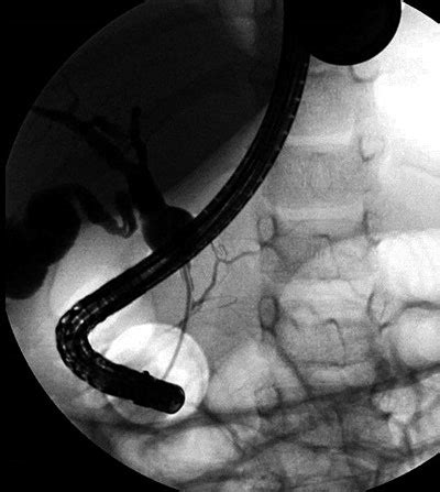 ERCP With Cholangiogram Demonstrating Type I Choledochal Cyst Download Scientific Diagram