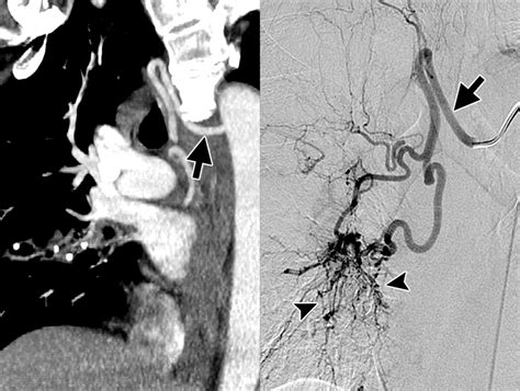 Bronchial Arteries Anatomy Function Hypertrophy And Anomalies