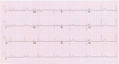 Digoxin Ekg