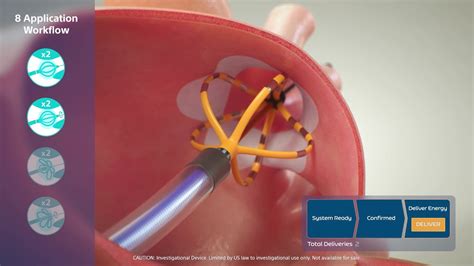 cardiac ablation medtronic at lee hamlett blog