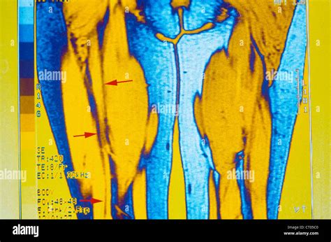 Nerf Sciatique Irm Photo Stock Alamy